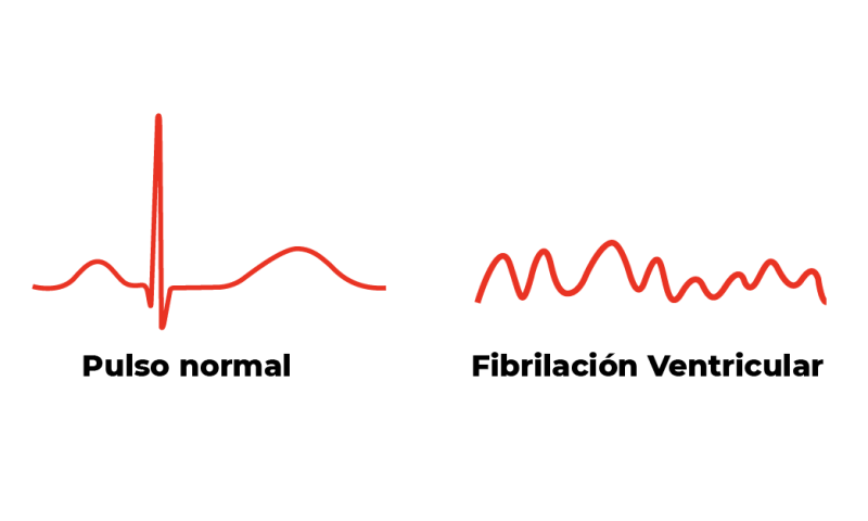Fibrilación Ventricular – DEACHILE